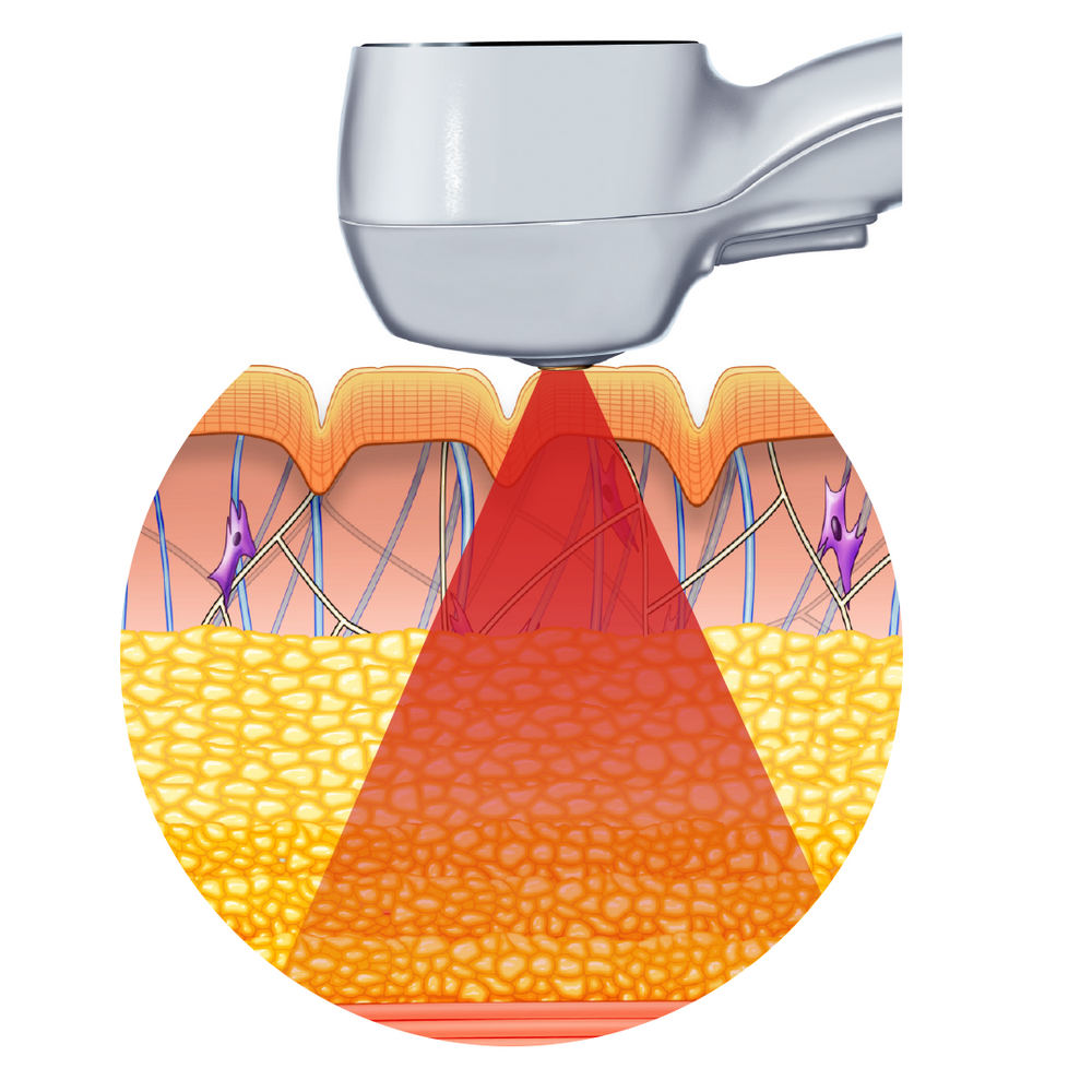 Exilis Ultra 360 Skin Tightening treatment Cost in Pune | Leor Clinics